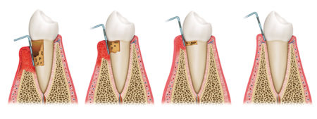 Qu’est-ce que le parodonte ? - Parodontologie Lot et Garonne
